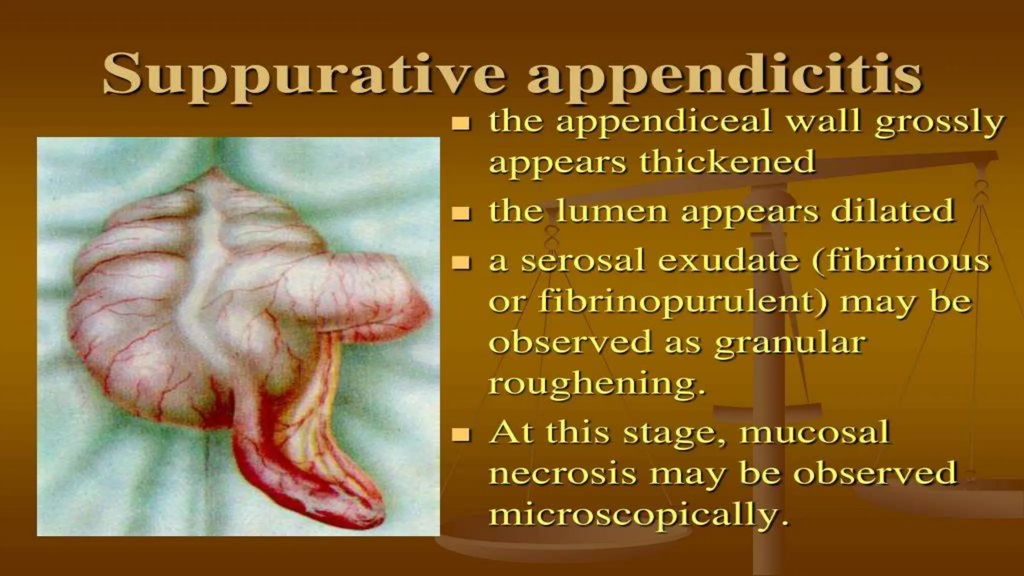 Classification of acute appendicitis.pptx