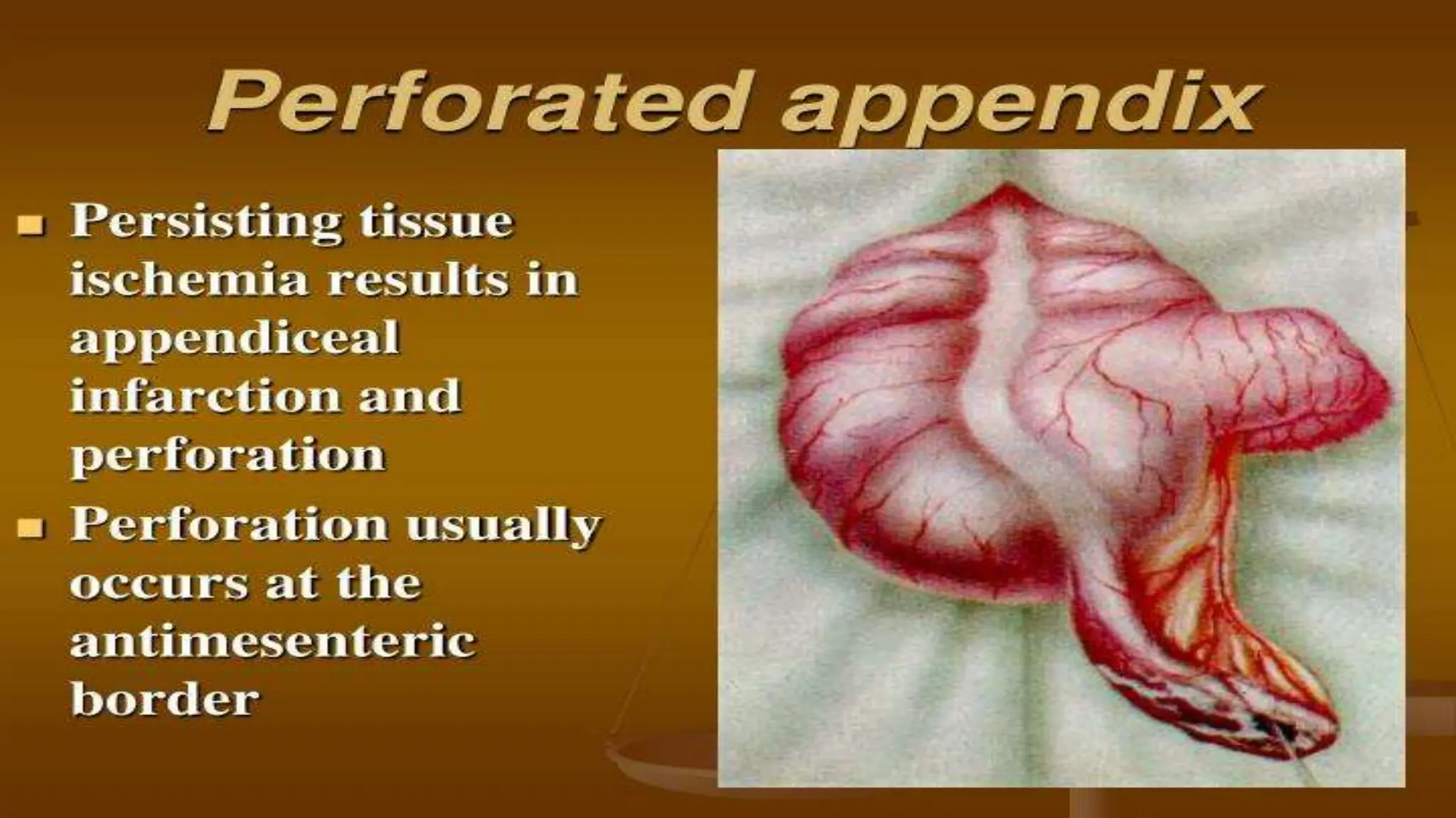 Classification of acute appendicitis.pptx