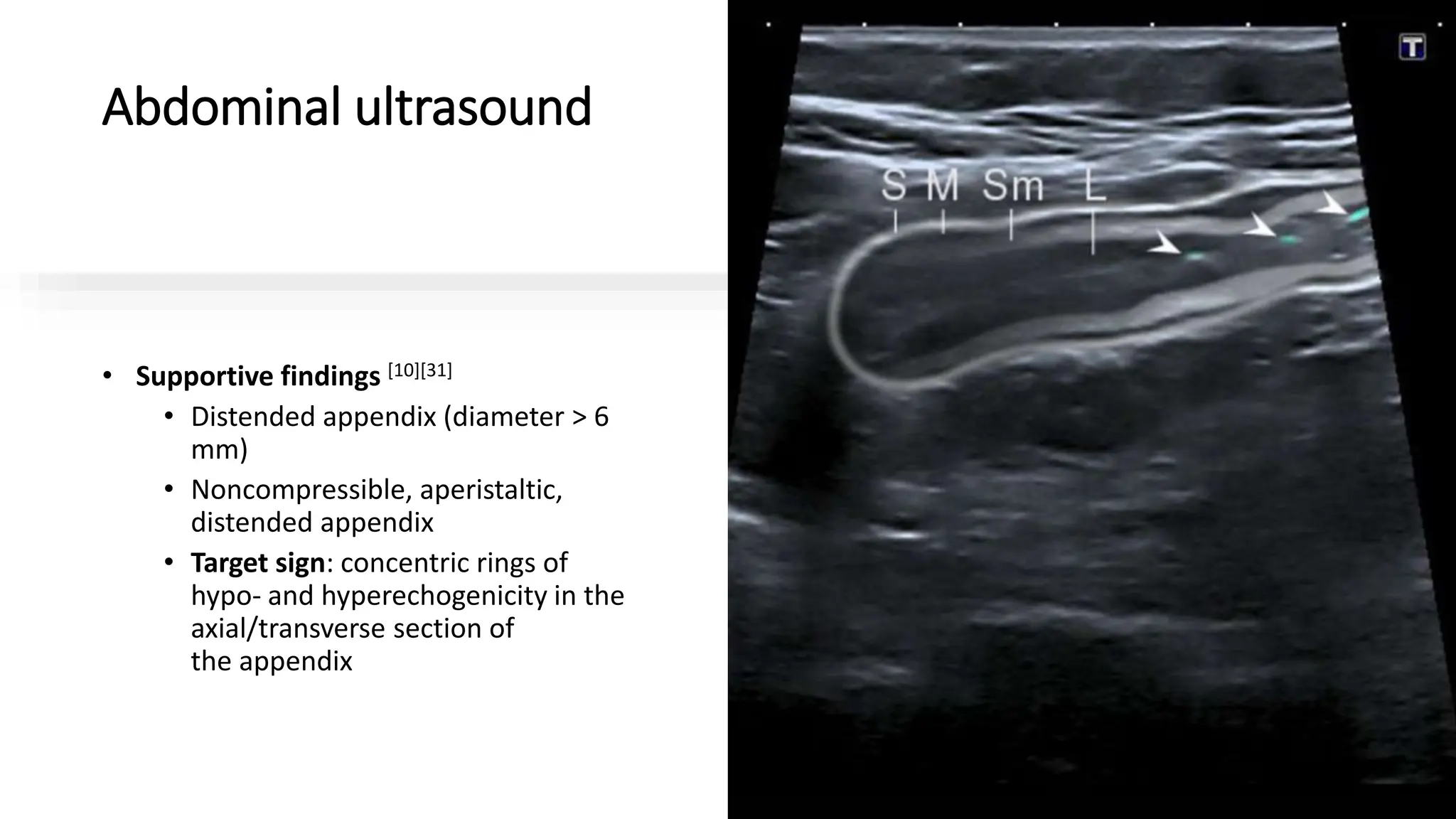 Classification of acute appendicitis.pptx