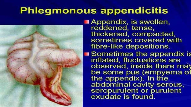 Classification of acute appendicitis.pptx
