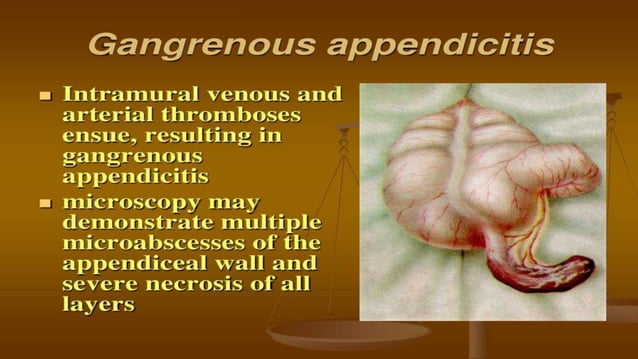 Classification of acute appendicitis.pptx