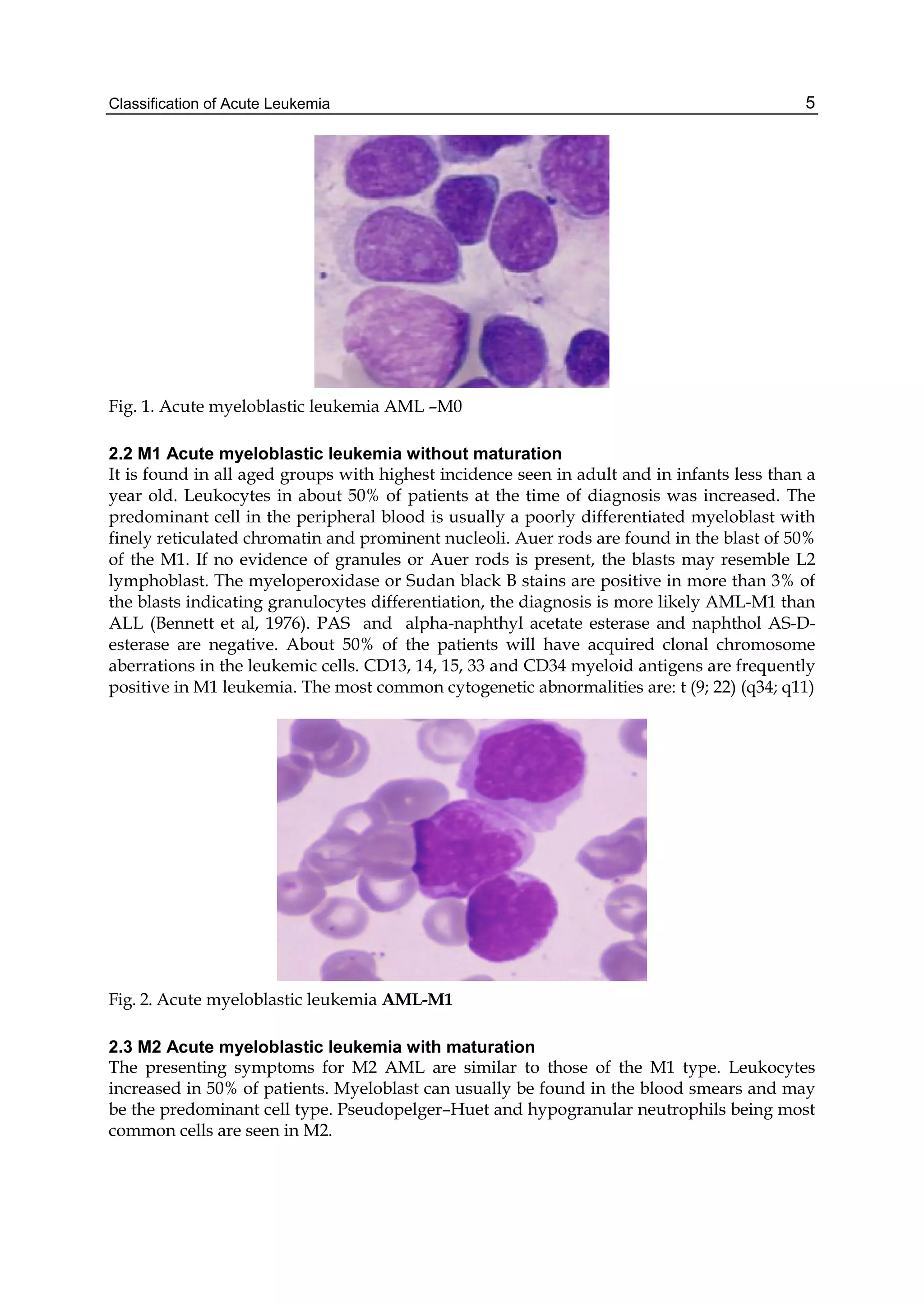 Classification of acute leukemia | PDF