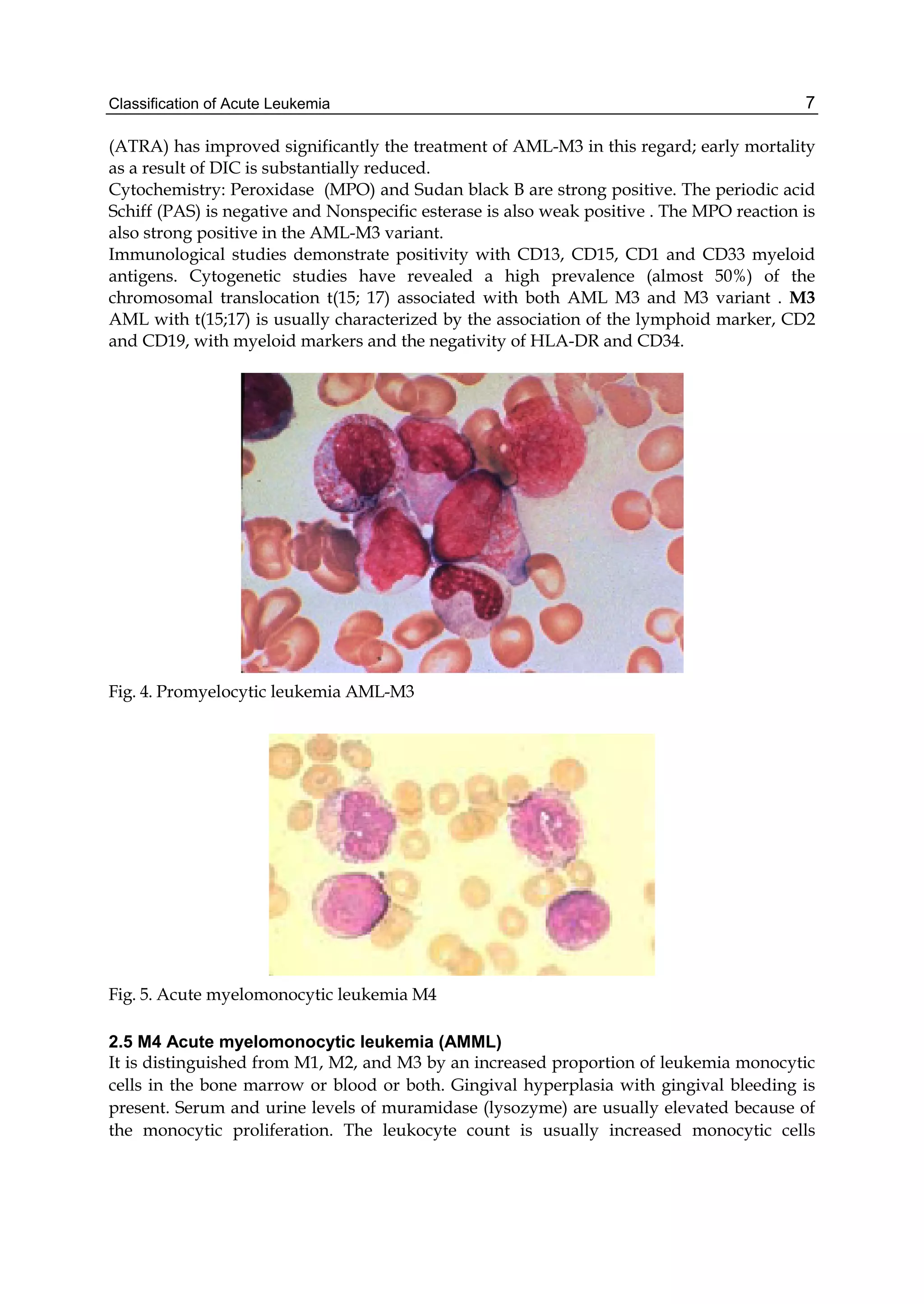 Classification of acute leukemia | PDF