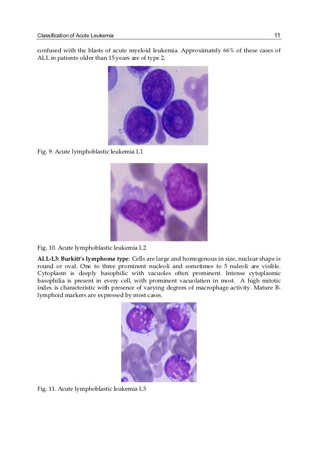 Classification of acute leukemia