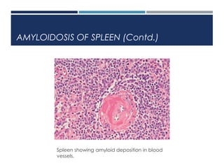 Amyloidosis Spleen
