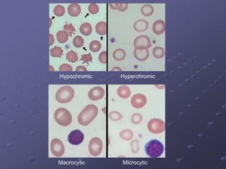 Classification of anem.JHIKUYHHKHIOUia.ppt | Blood Disorders | Diseases ...