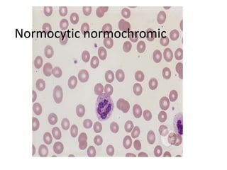 Classification of anemias | PPTX