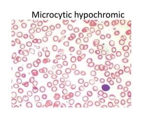 Classification of anemias | PPTX