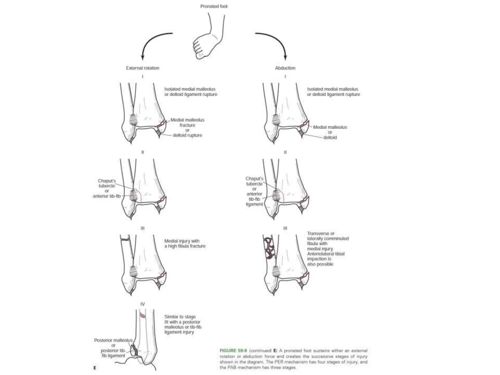 CLASSIFICATION OF ANKLE FRACTURES in orthopaedics | PPTX