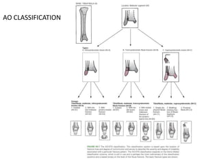 CLASSIFICATION OF ANKLE FRACTURES in orthopaedics | PPTX