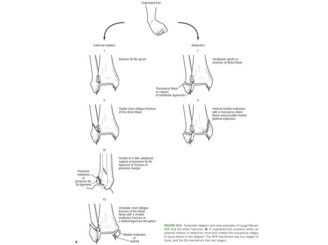 CLASSIFICATION OF ANKLE FRACTURES in orthopaedics | PPTX