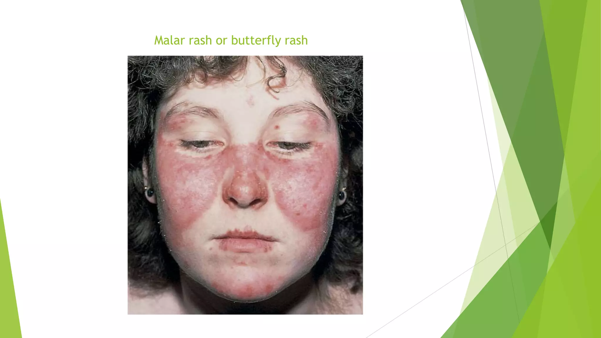 CLASSIFICATION OF ORAL AUTOIMMUNE DISORDERS | PPTX