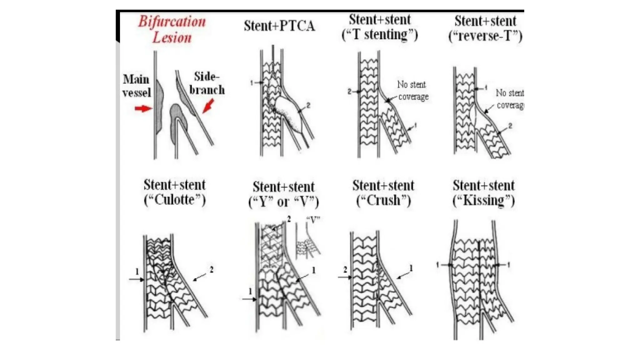 Classification of bifurcation lesion angioplasty | PPTX