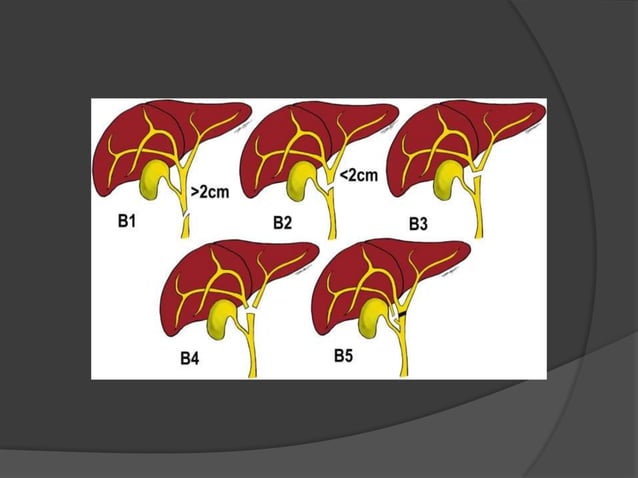 CLASSIFICATION OF BILE DUCT INJURY.pptx