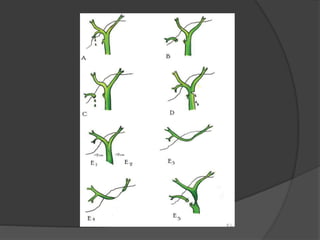 Stewart Way Classification
