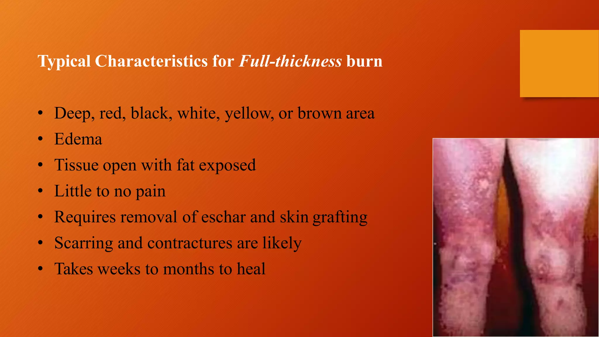 Classification of burn by dr. ali mujatba | PPTX