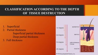Classification of burn by dr. ali mujatba | PPTX