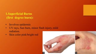 Classification of burn by dr. ali mujatba | PPTX