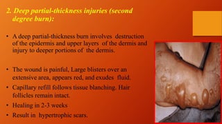 Classification of burn by dr. ali mujatba | PPTX