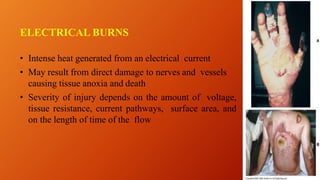 Classification of burn by dr. ali mujatba | PPTX