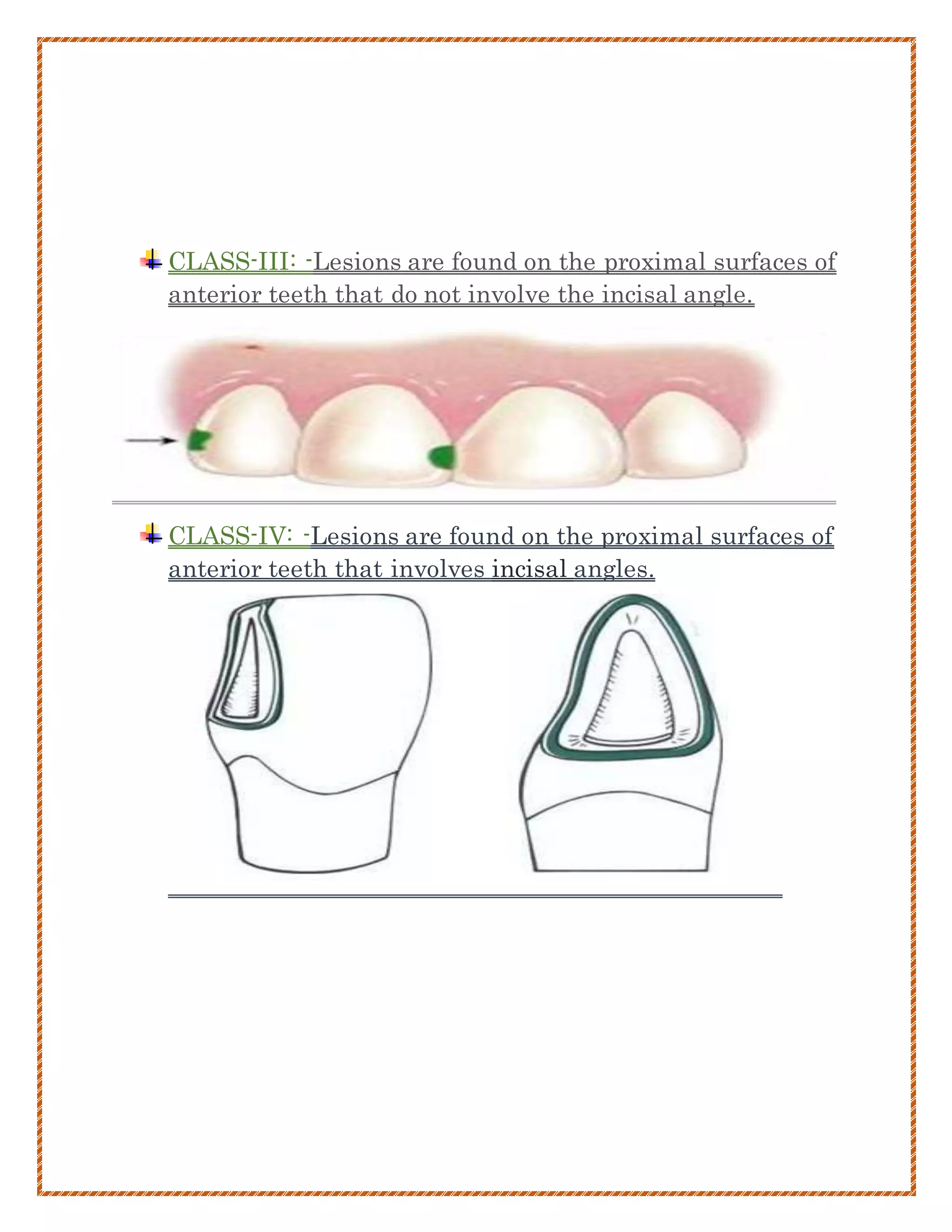 Classification of cavities | DOCX