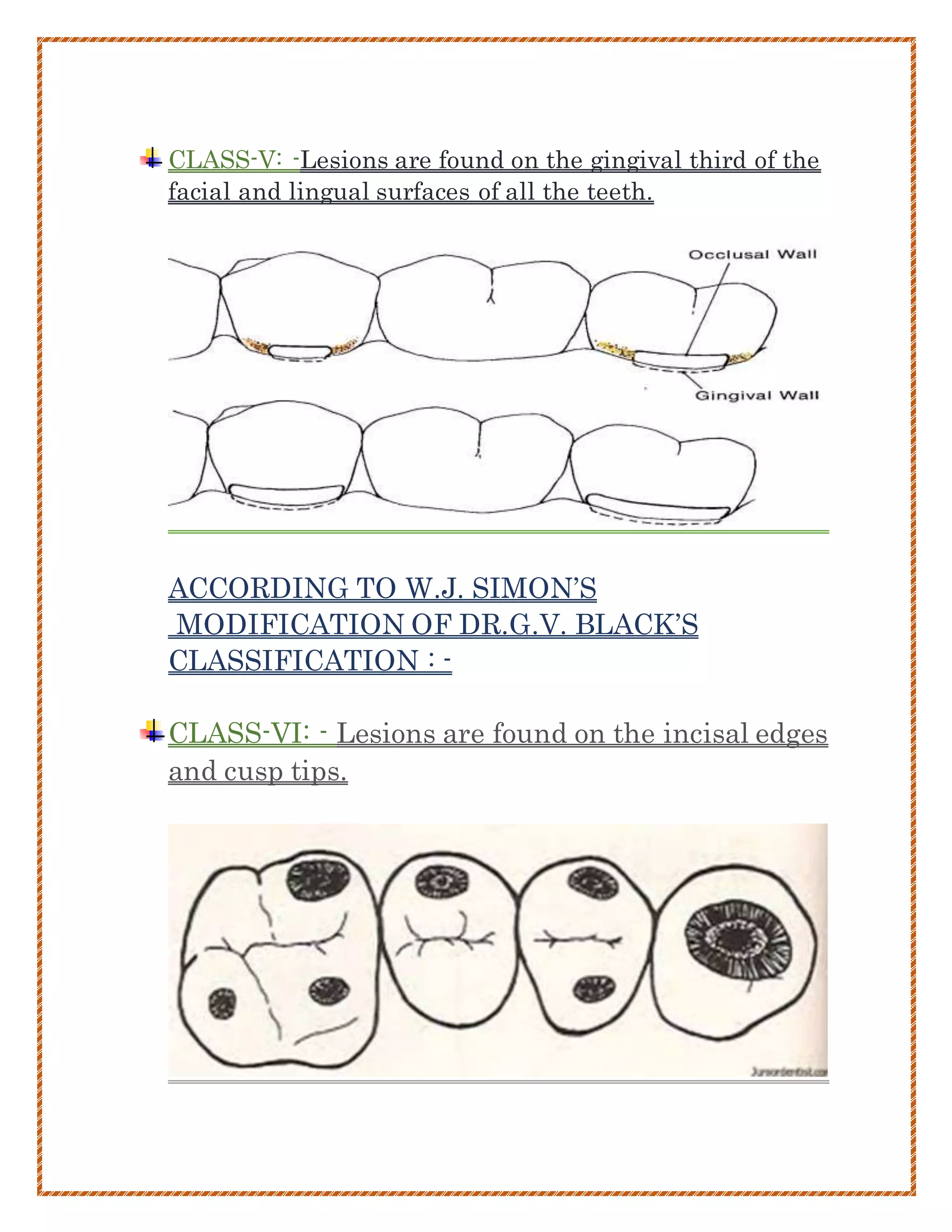 Classification of cavities | DOCX