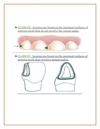 Classification of cavities | DOCX