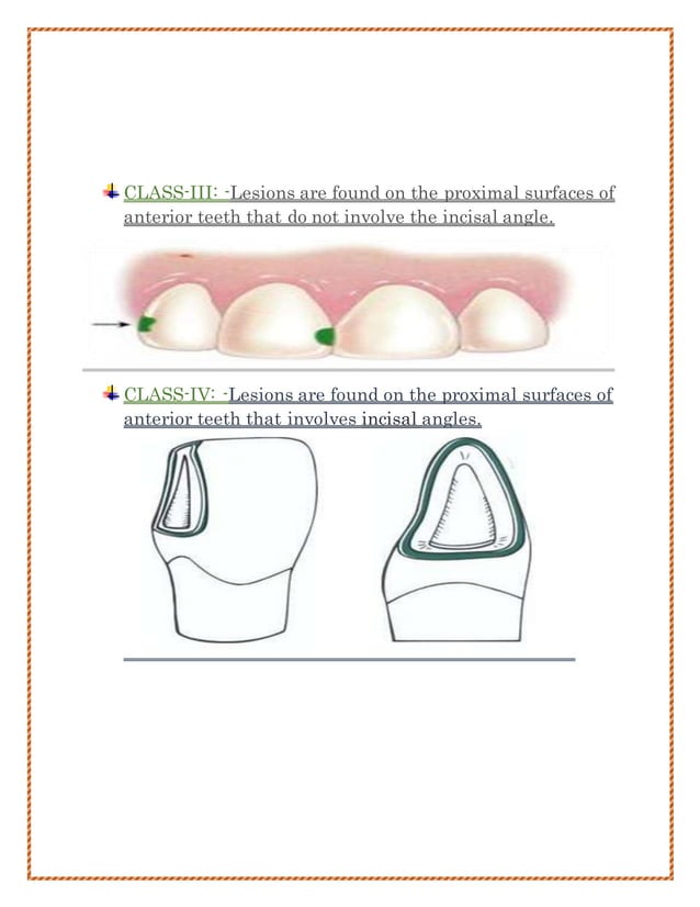 Classification of cavities | PDF