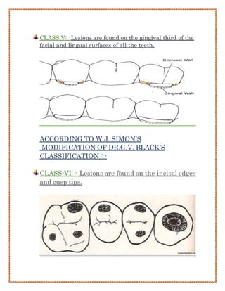Classification of cavities | DOCX