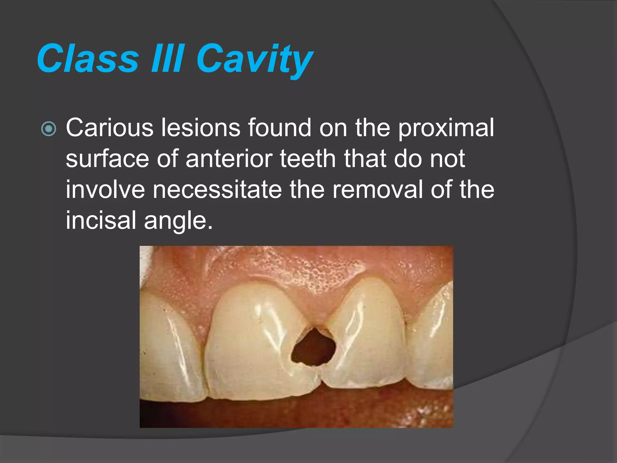 Classification of cavity cutting | PPTX