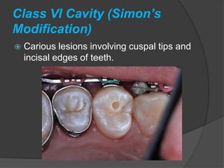 Classification of cavity cutting | PPTX