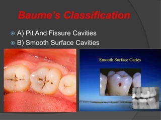 Classification of cavity cutting | PPTX