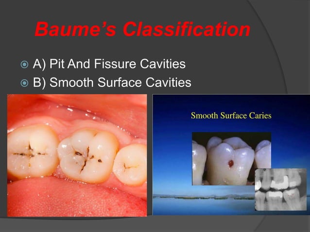 Classification of cavity cutting | PPTX | Dental Health | Diseases and ...