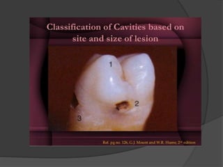 Classification of cavity cutting | PPTX