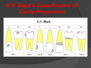 Classification of cavity cutting | PPTX