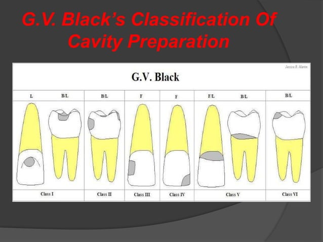 Classification of cavity cutting | PPTX | Dental Health | Diseases and ...