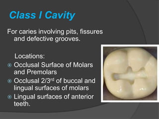 Classification of cavity cutting | PPTX
