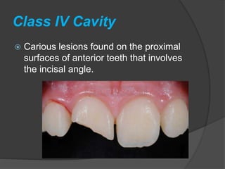 Classification of cavity cutting | PPTX | Dental Health | Diseases and Conditions