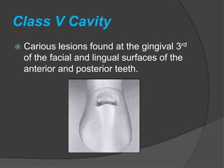 Classification of cavity cutting | PPTX