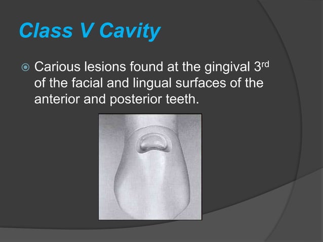 Classification of cavity cutting | PPTX | Dental Health | Diseases and ...