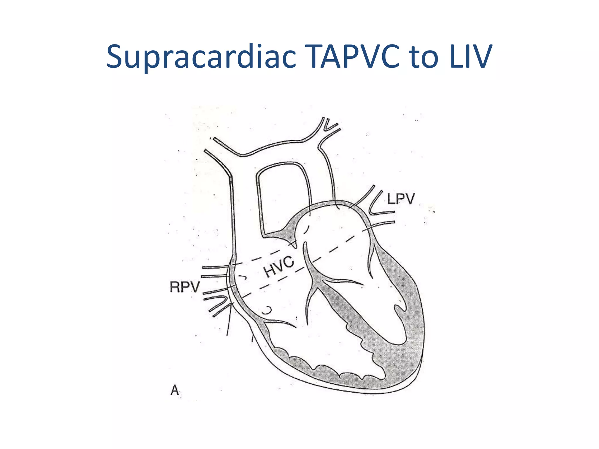 Classification of chd | PPTX