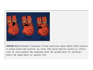 Classification of chd | PPTX