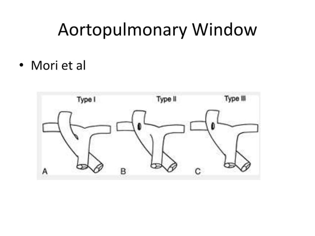 Classification of chd | PPTX