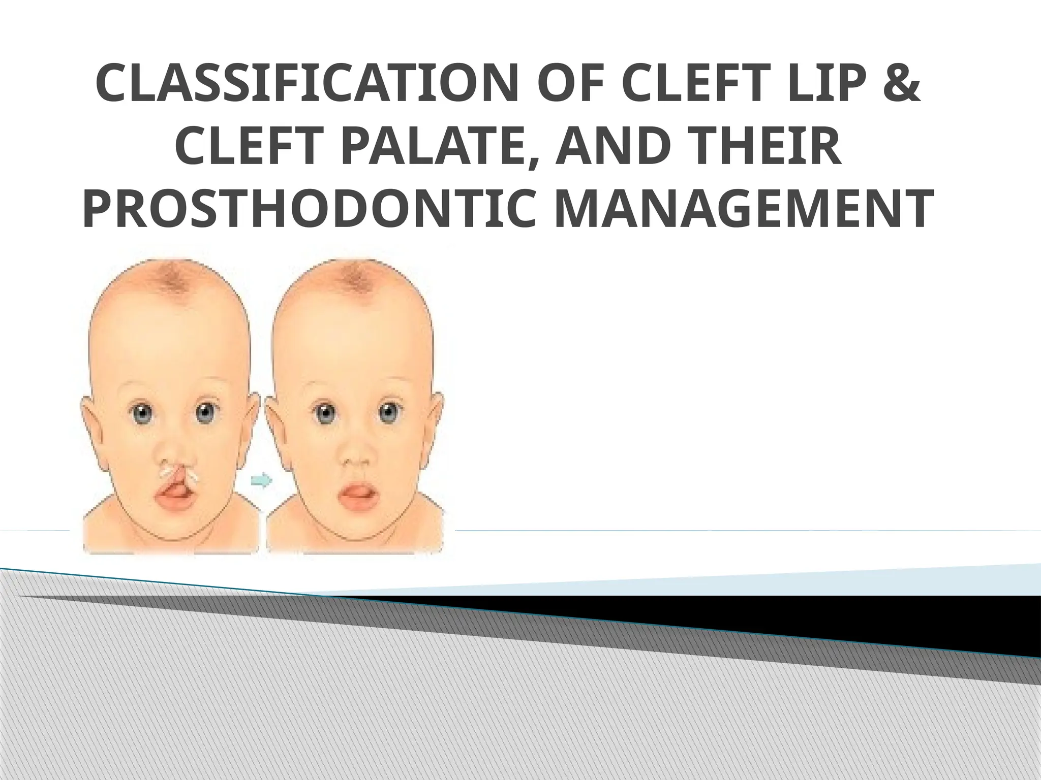CLASSIFICATION OF CLEFT LIP & CLEFT PALATE, AND THEIR PROSTHODONTIC MANAGEMENT.pptx