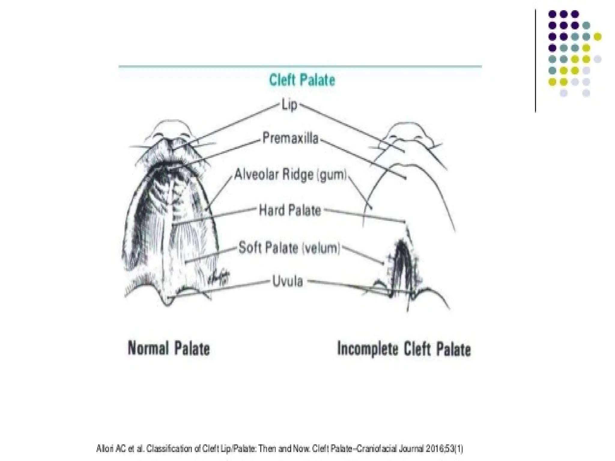 CLASSIFICATION OF CLEFT LIP & CLEFT PALATE, AND THEIR PROSTHODONTIC ...
