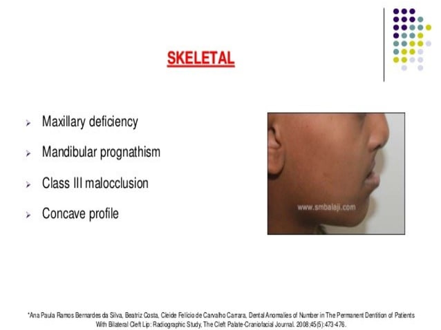 CLASSIFICATION OF CLEFT LIP & CLEFT PALATE, AND THEIR PROSTHODONTIC ...
