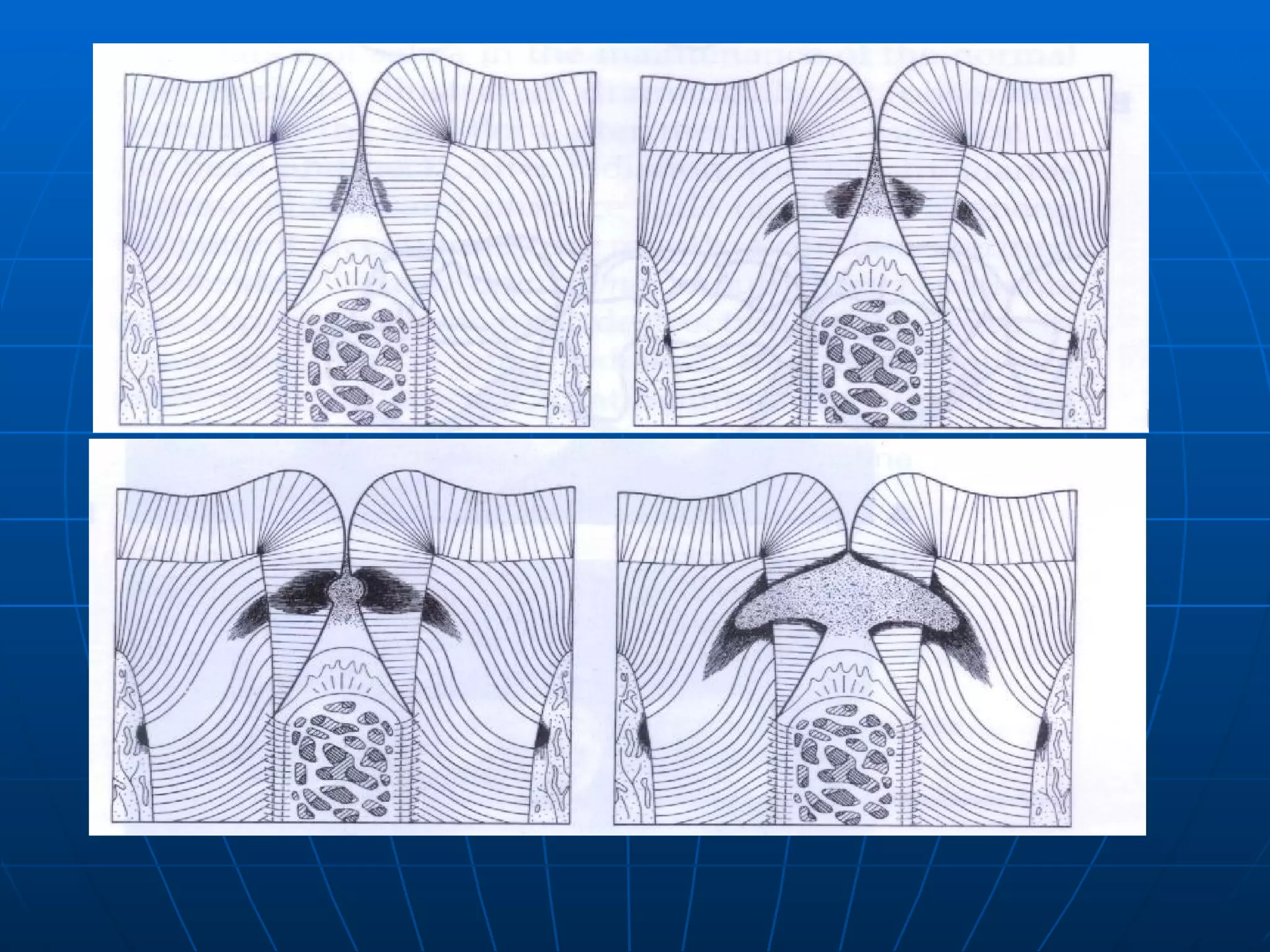 Classification Of Dental Caries | PPT