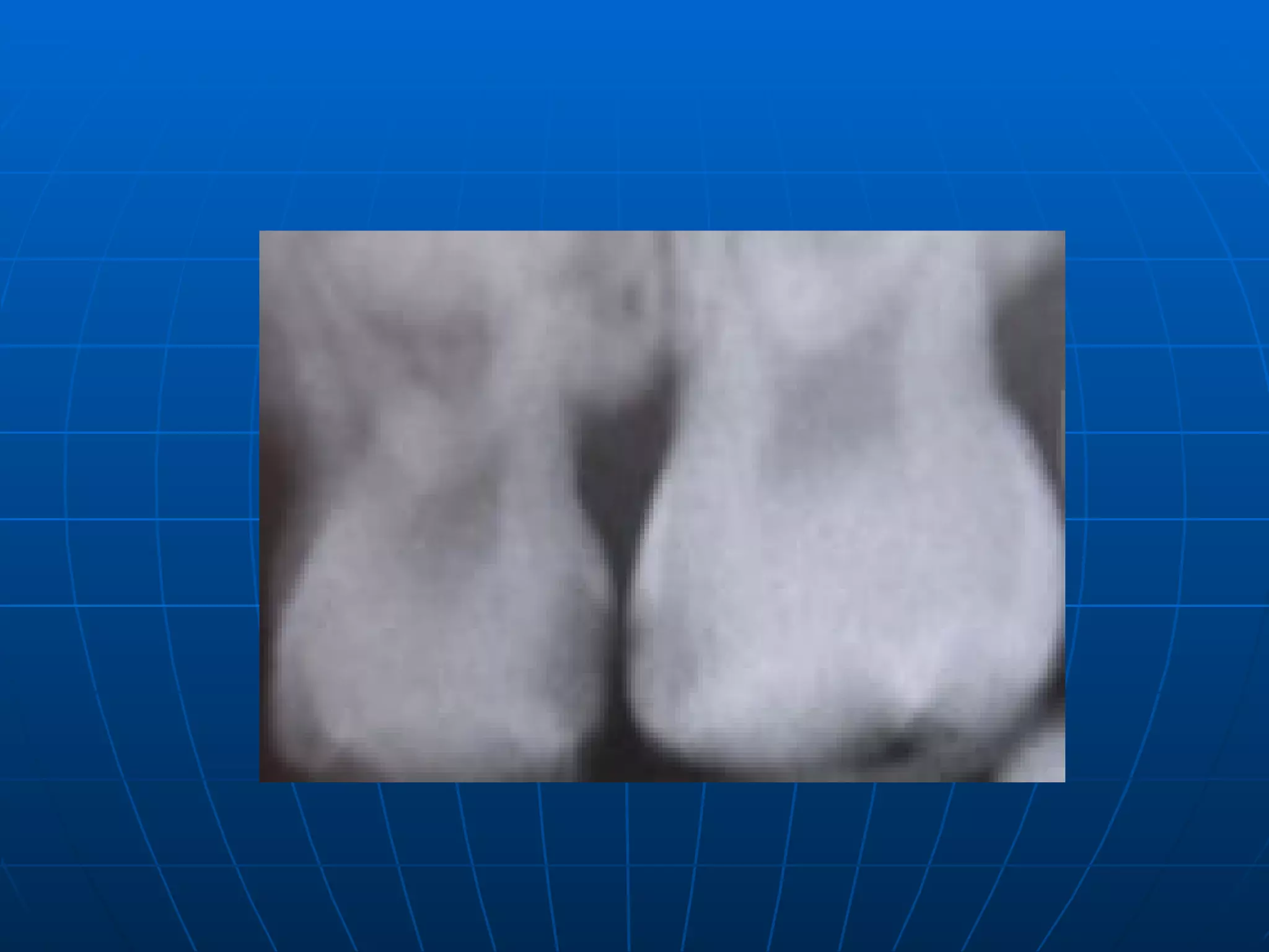 Classification Of Dental Caries | PPT