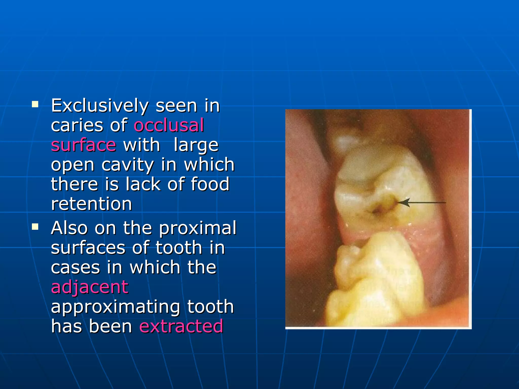 Classification Of Dental Caries | PPT