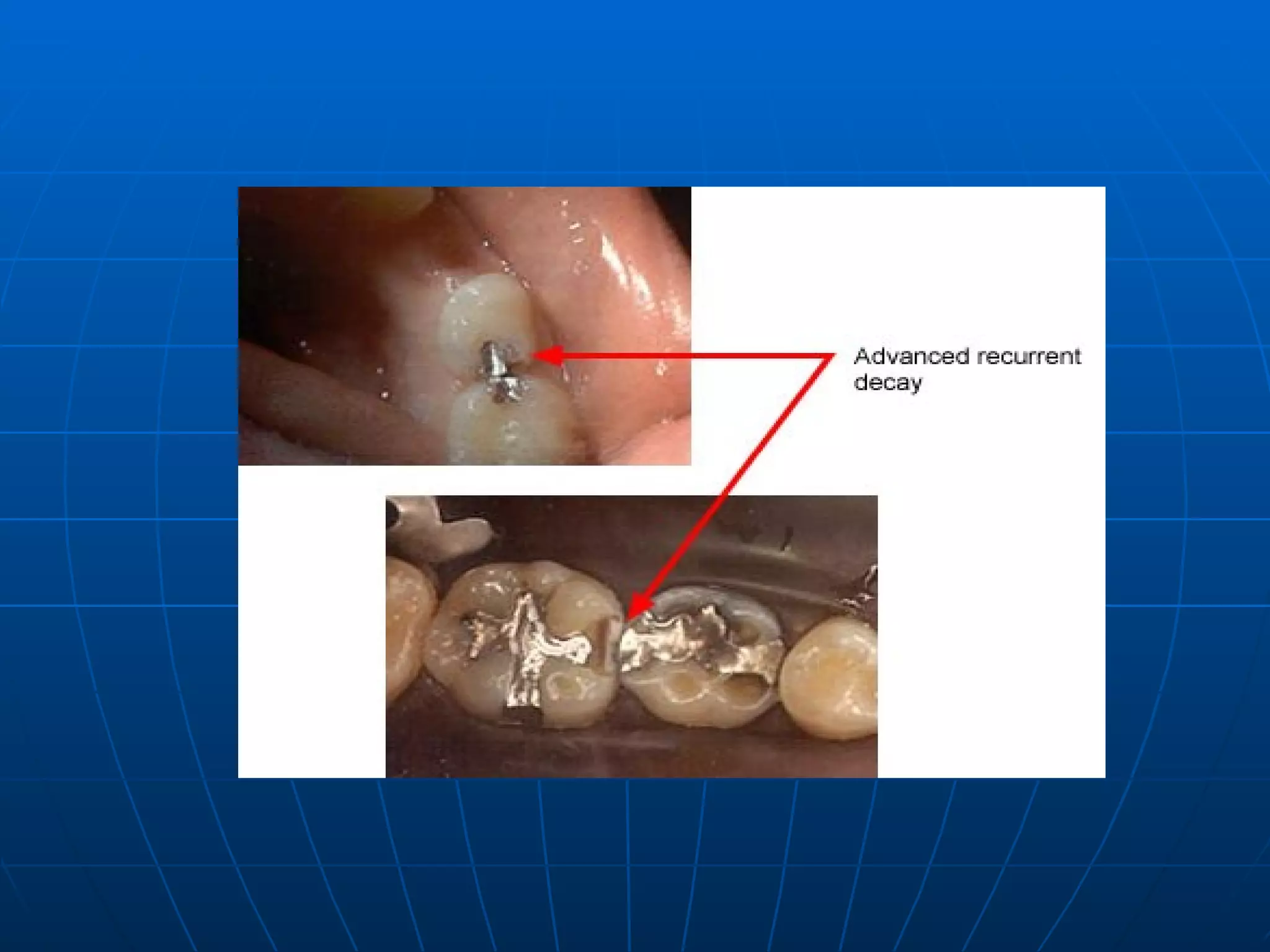 Classification Of Dental Caries Ppt